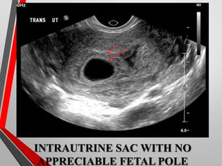 Ectopic pregnancy Radiology | PPTX