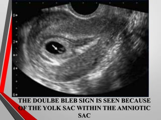 Ectopic pregnancy Radiology | PPTX