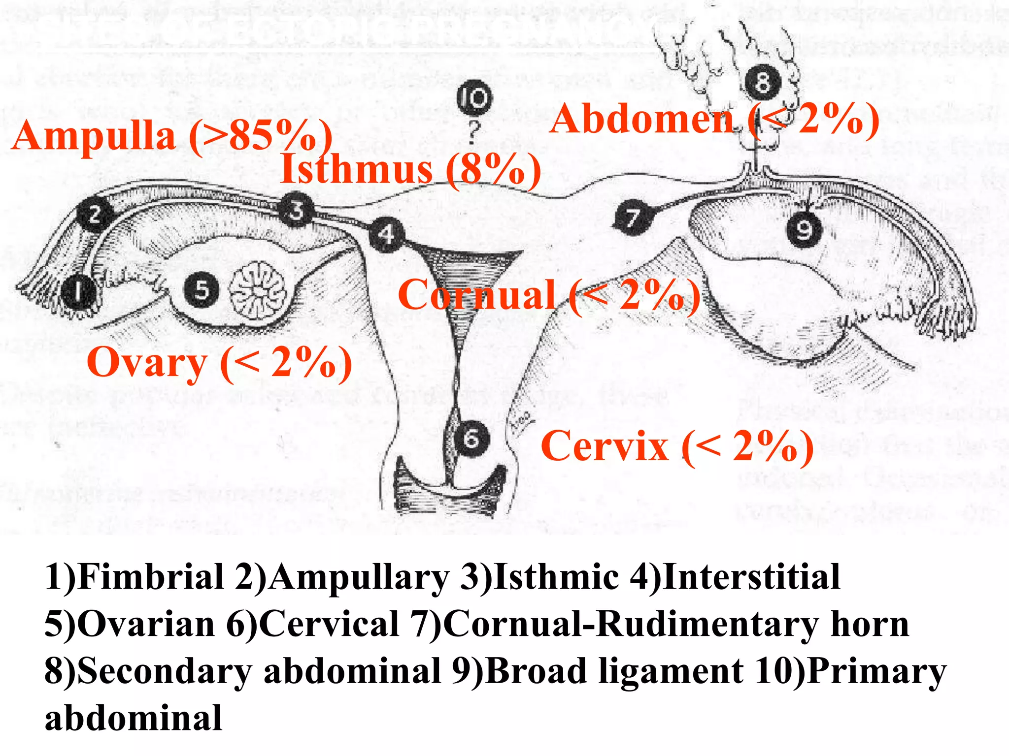 Ectopic pregnancy future fertiliy | PPTX