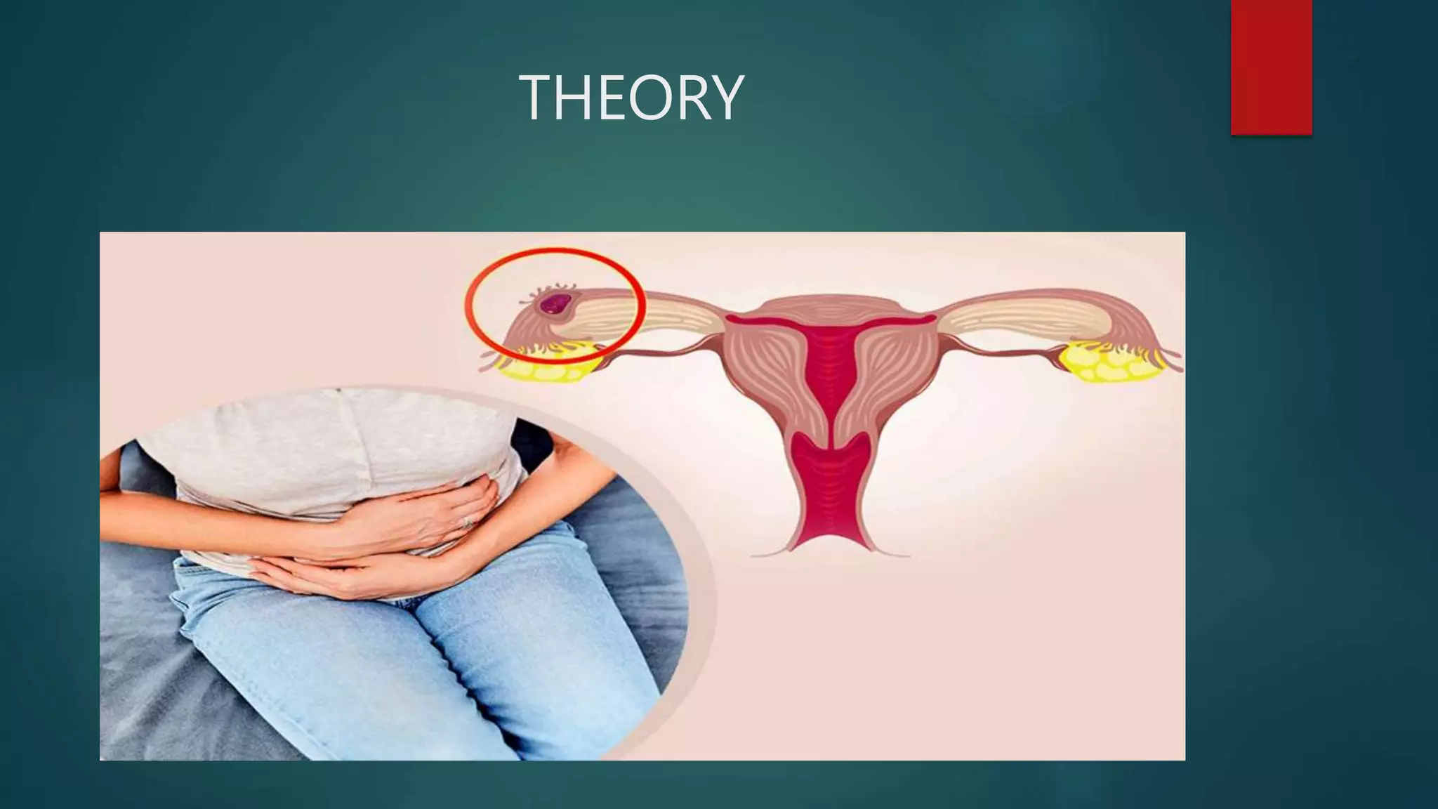 ectopic pregnancy( half gee and quiver).pptx