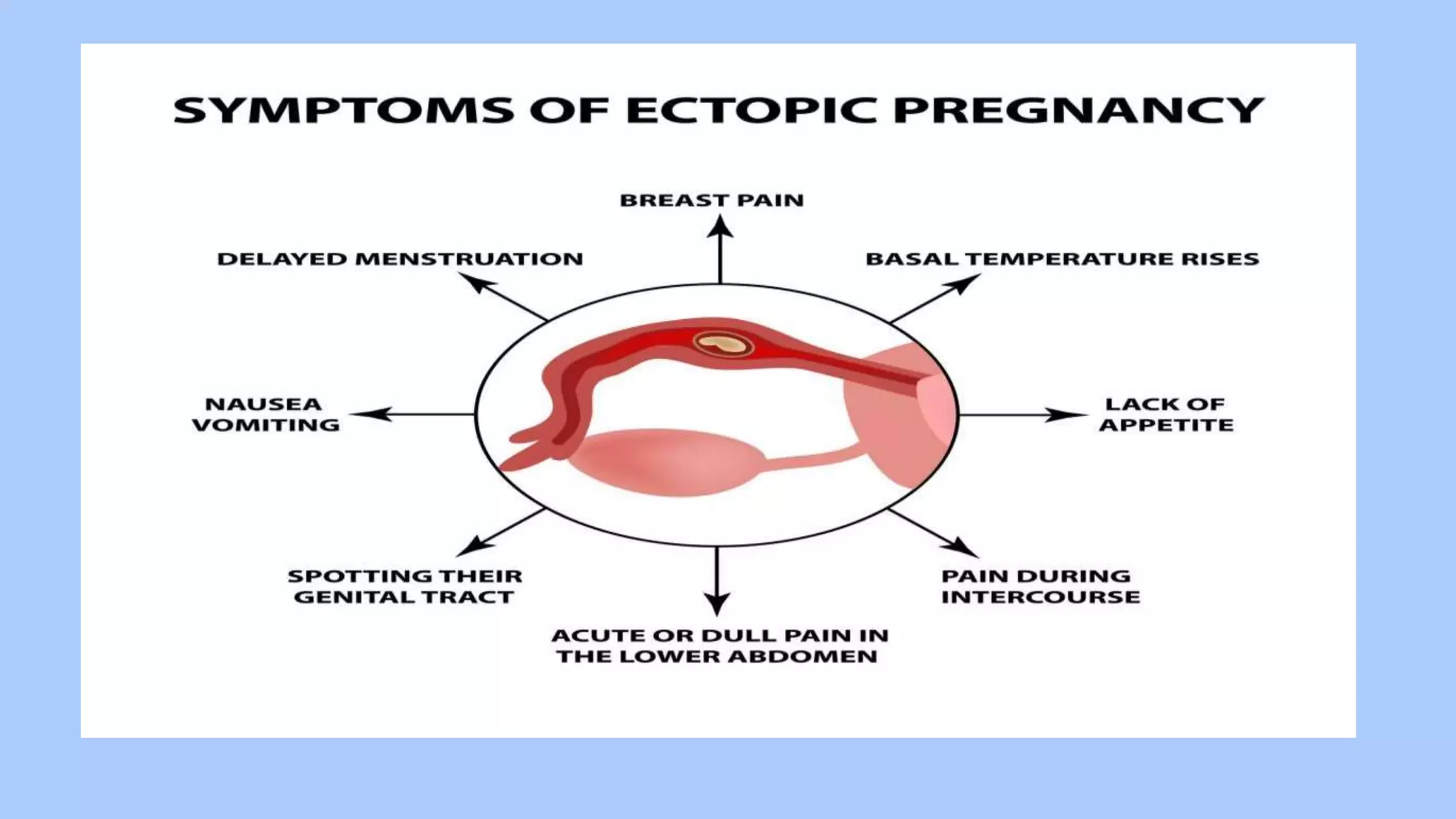 ECTOPIC PREGNANCY lecture.pptx