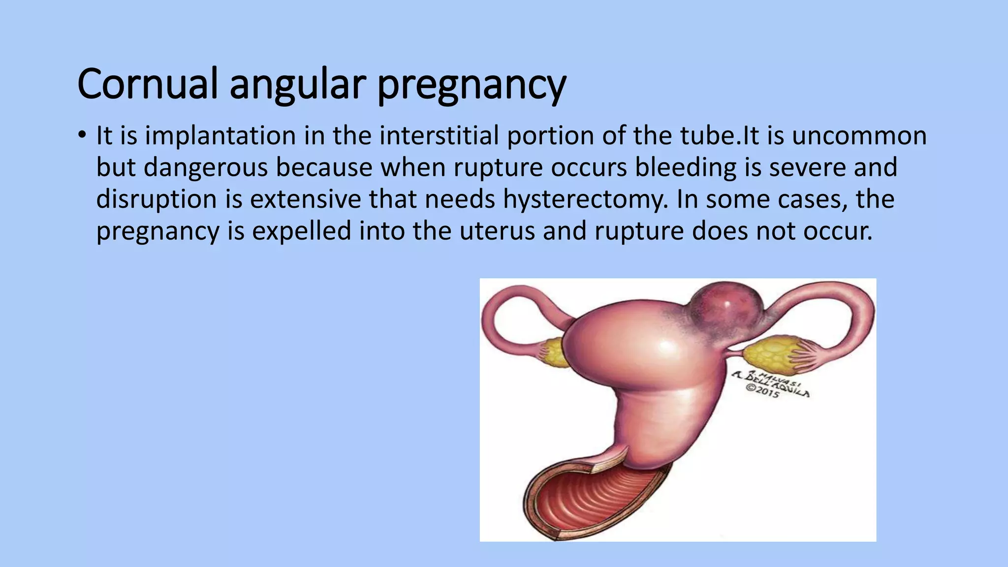 ECTOPIC PREGNANCY lecture.pptx
