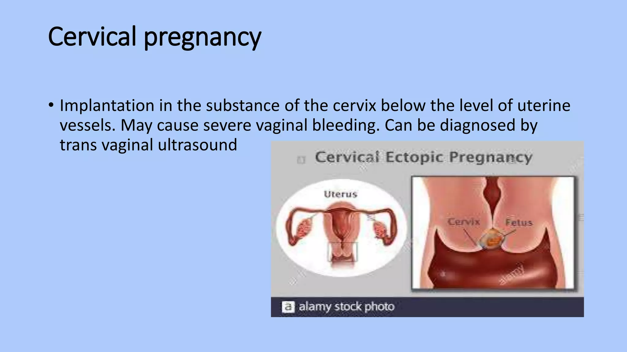 ECTOPIC PREGNANCY lecture.pptx