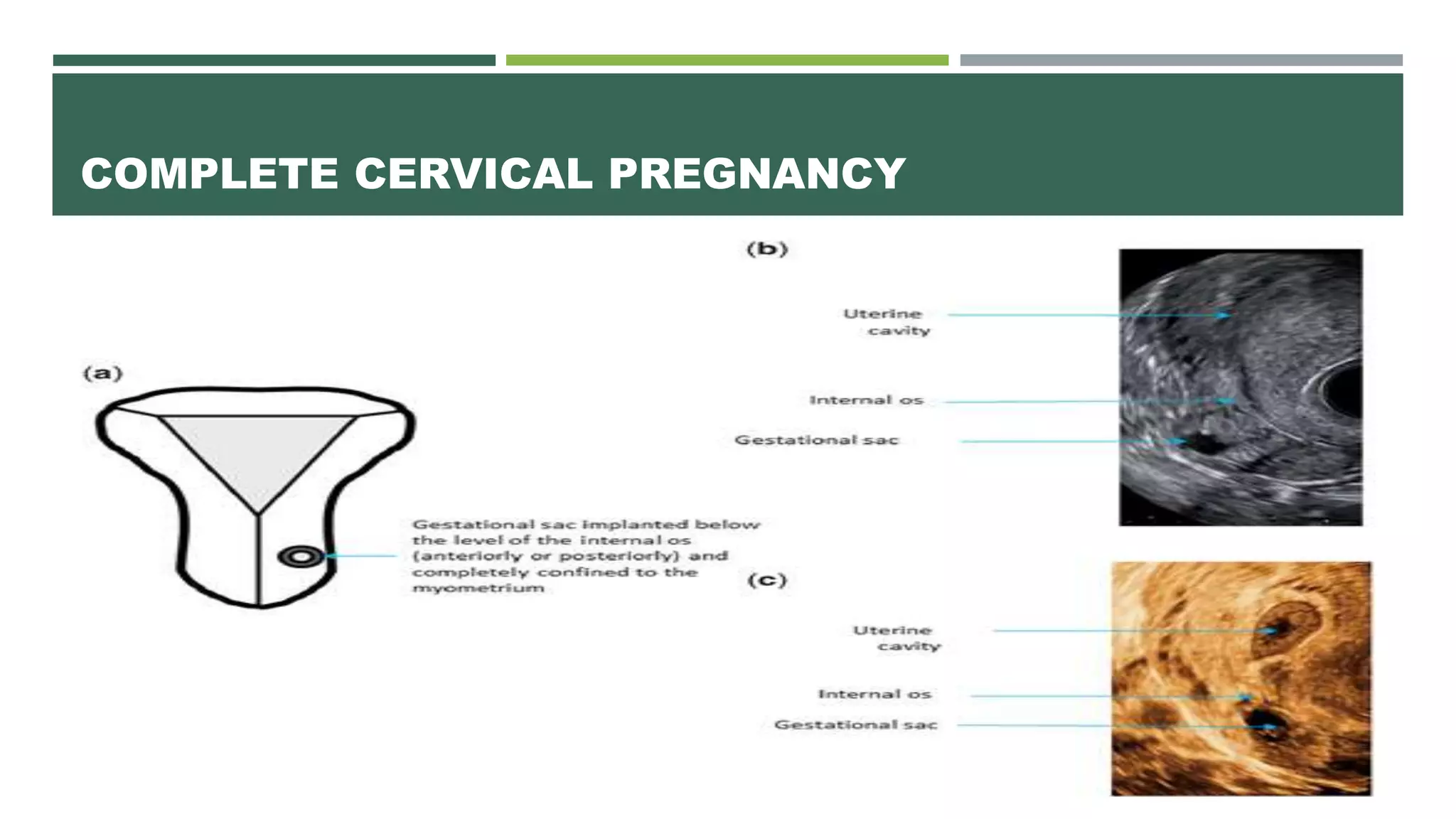 Ectopic Pregnancy: New ESHRE terminology | PPTX