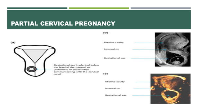 Ectopic Pregnancy: New ESHRE terminology | PPT