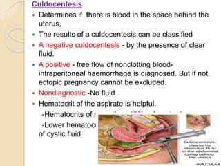 Ectopic pregnancy pannel discussion | PPTX
