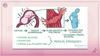 Ectopic Pregnancy : Definition, Triad, Diagnosis, and Treatment | PPTX