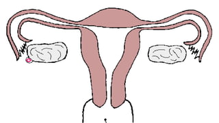 Ectopic Pregnancy : Definition, Triad, Diagnosis, and Treatment | PPTX