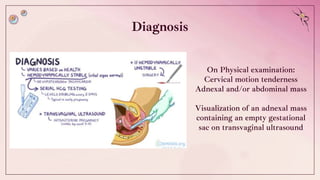 Ectopic Pregnancy : Definition, Triad, Diagnosis, and Treatment | PPTX
