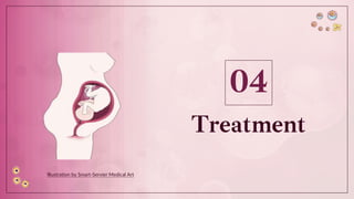 Ectopic Pregnancy : Definition, Triad, Diagnosis, and Treatment | PPTX