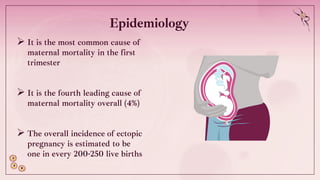 Ectopic Pregnancy : Definition, Triad, Diagnosis, and Treatment | PPTX