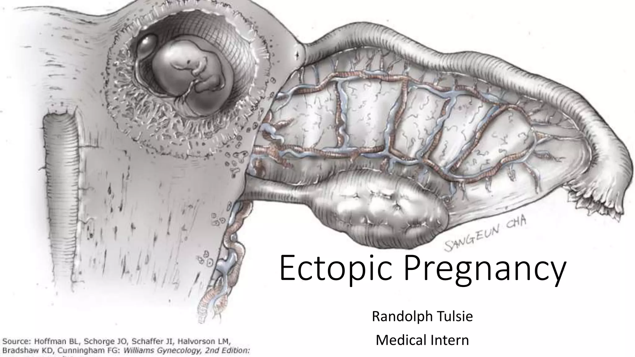 Ectopic Pregnancy | PPTX | Infertility | Reproductive Health
