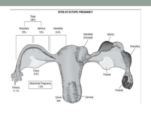 Ectopic pregnancy rs