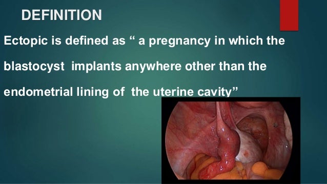 Ectopic pregnancy