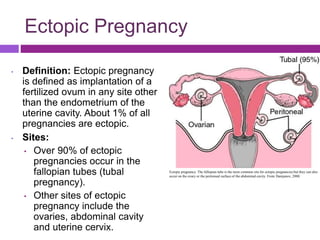Pathology of Ectopic pregnancy, spontaneous abortion and gestational ...