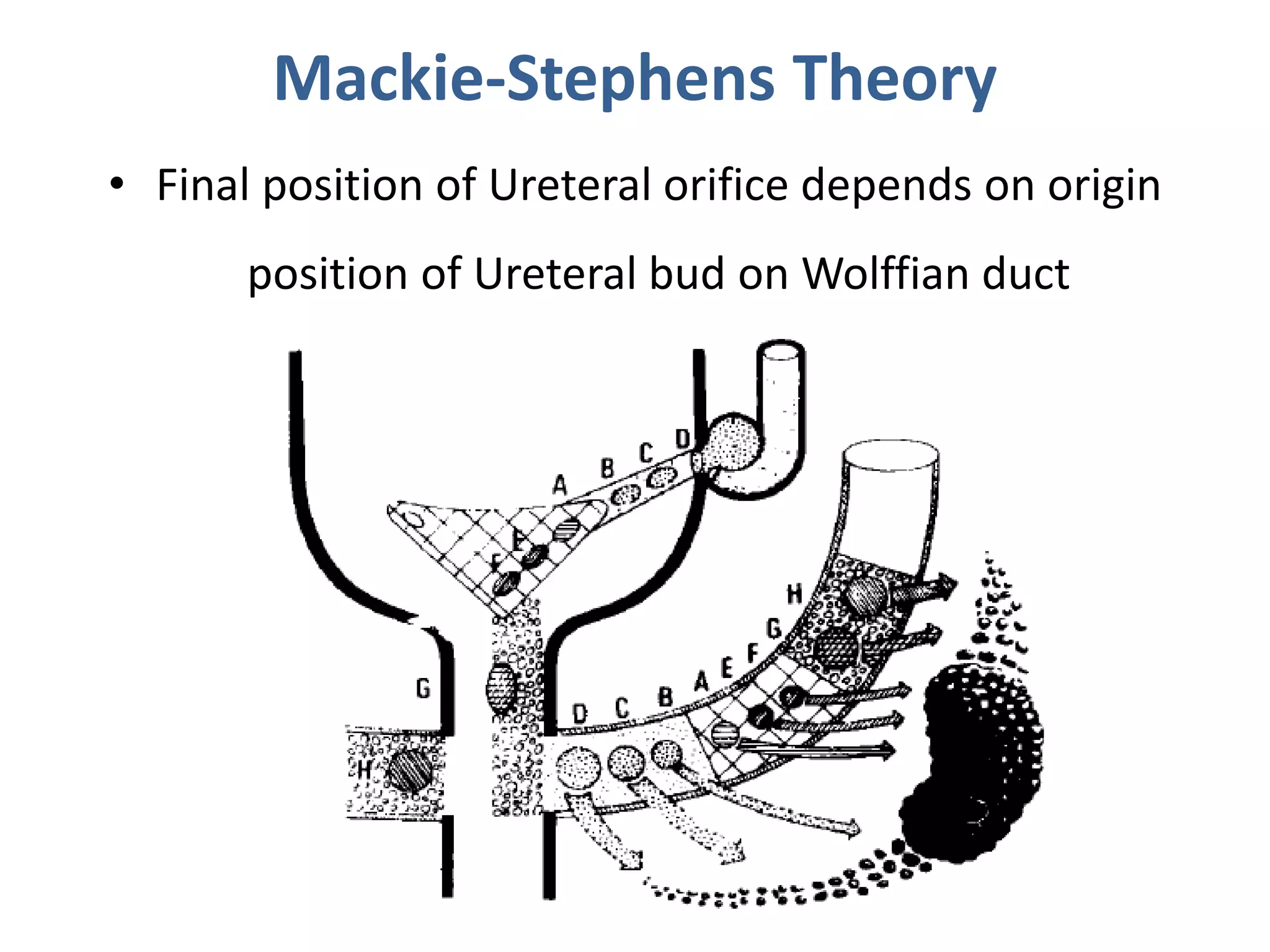Ectopic ureter and ureterocele - Embryology and Presentation | PPTX