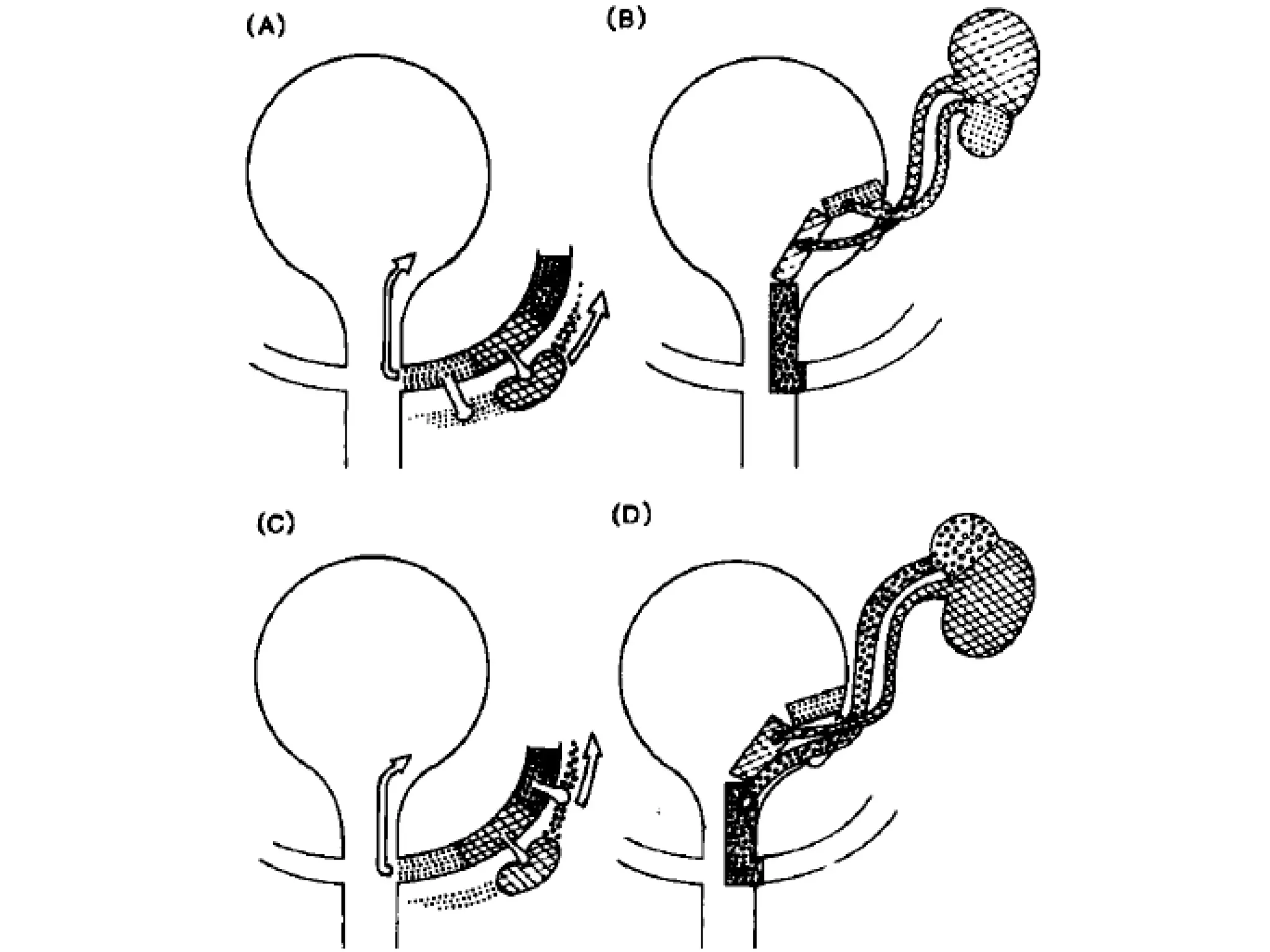 Ectopic ureter and ureterocele - Embryology and Presentation | PPTX