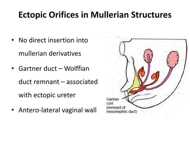 Ectopic ureter and ureterocele - Embryology and Presentation | PPTX