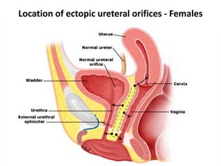 Ectopic ureter and ureterocele - Embryology and Presentation | PPTX