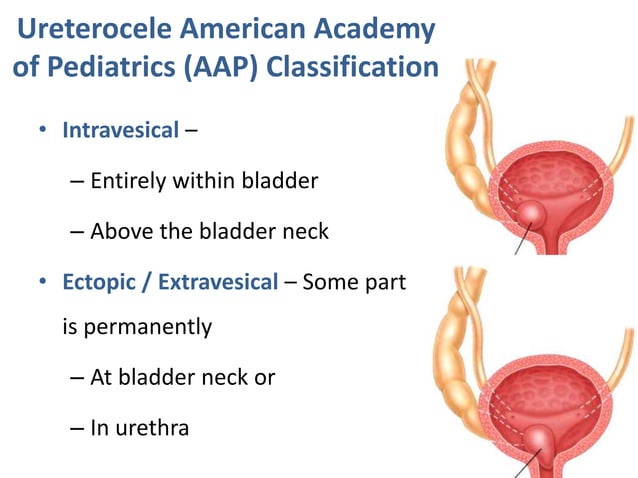 Ectopic ureter and ureterocele - Embryology and Presentation | PPTX