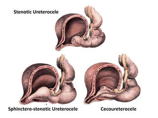 Ectopic ureter and ureterocele - Embryology and Presentation | PPTX