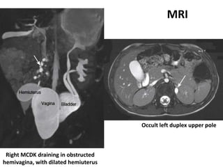 Ectopic ureter and ureterocele - Embryology and Presentation | PPTX