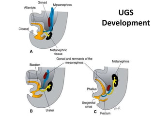 Ectopic ureter and ureterocele - Embryology and Presentation | PPTX