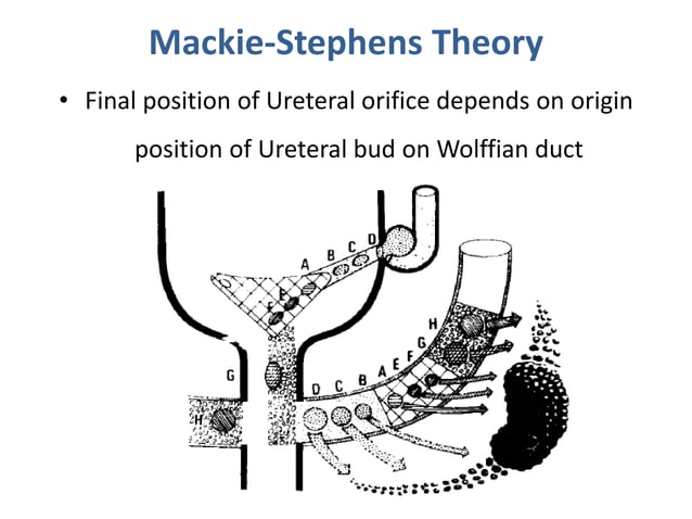 Ectopic ureter and ureterocele - Embryology and Presentation | PPTX