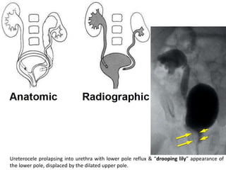 Prolapsed Ureterocele