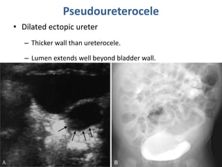 Ureterocele Ivp