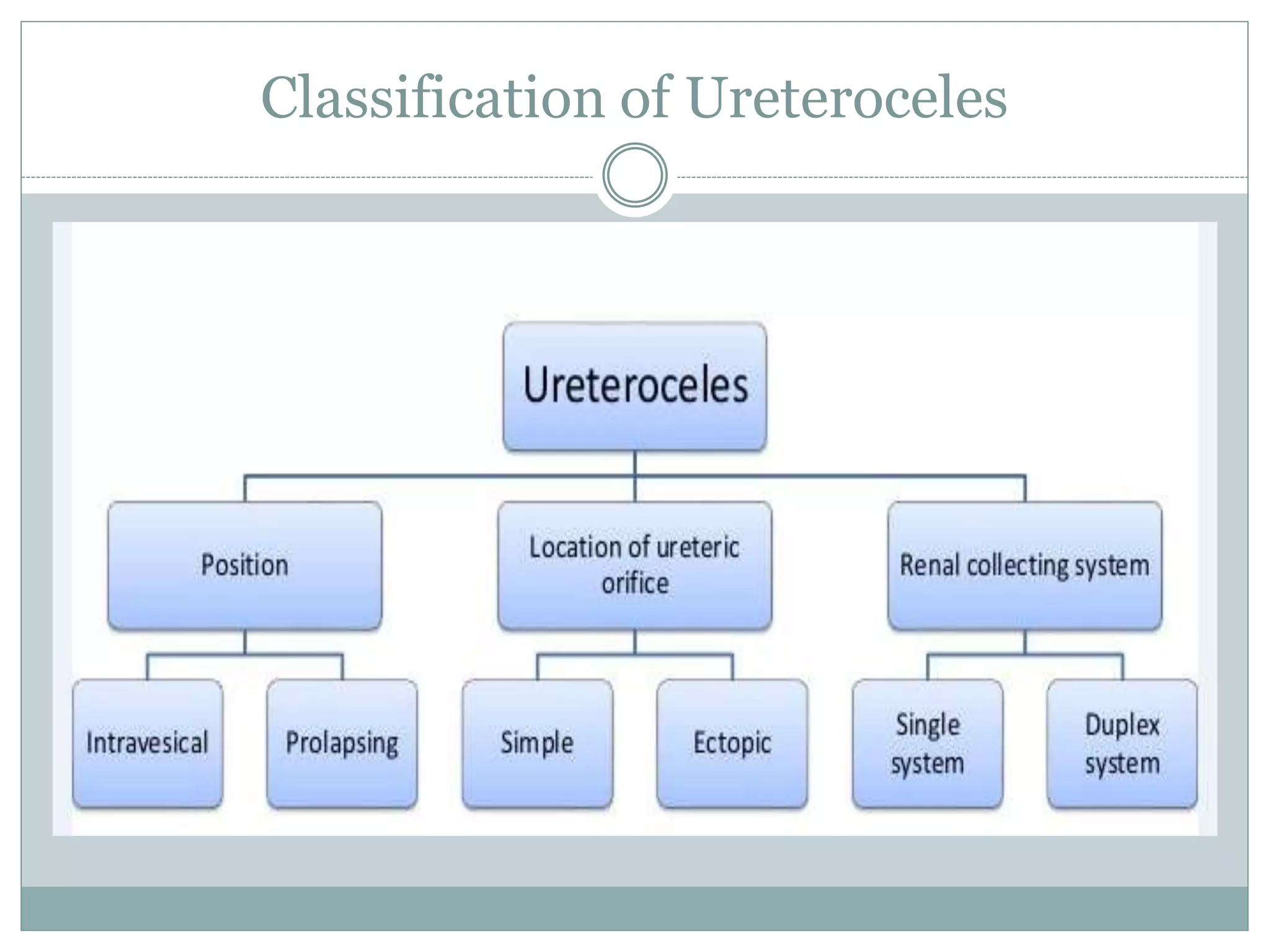 Ectopic ureter & ureterocoele | PPTX