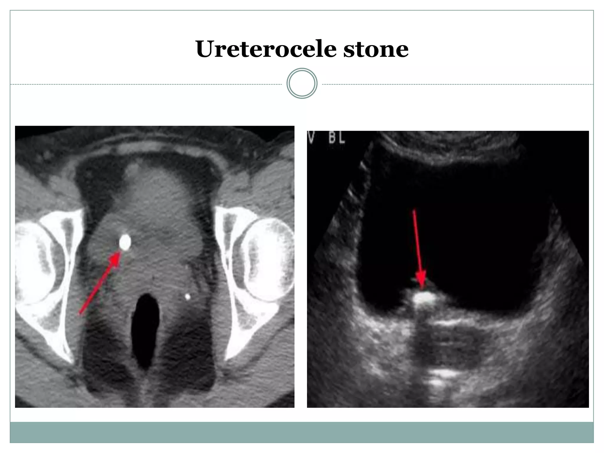 Ectopic ureter & ureterocoele | PPTX