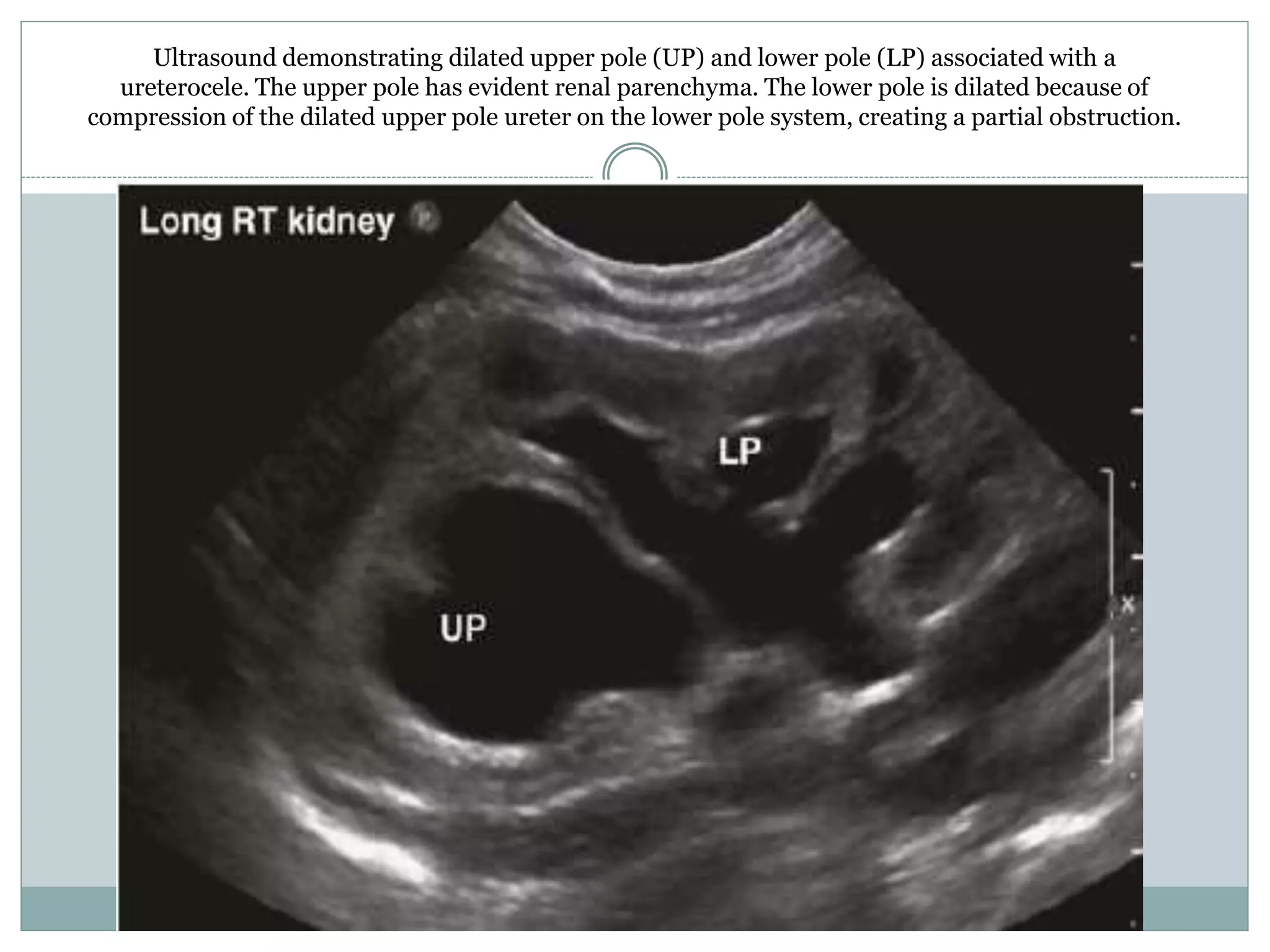 Ectopic ureter & ureterocoele | PPTX