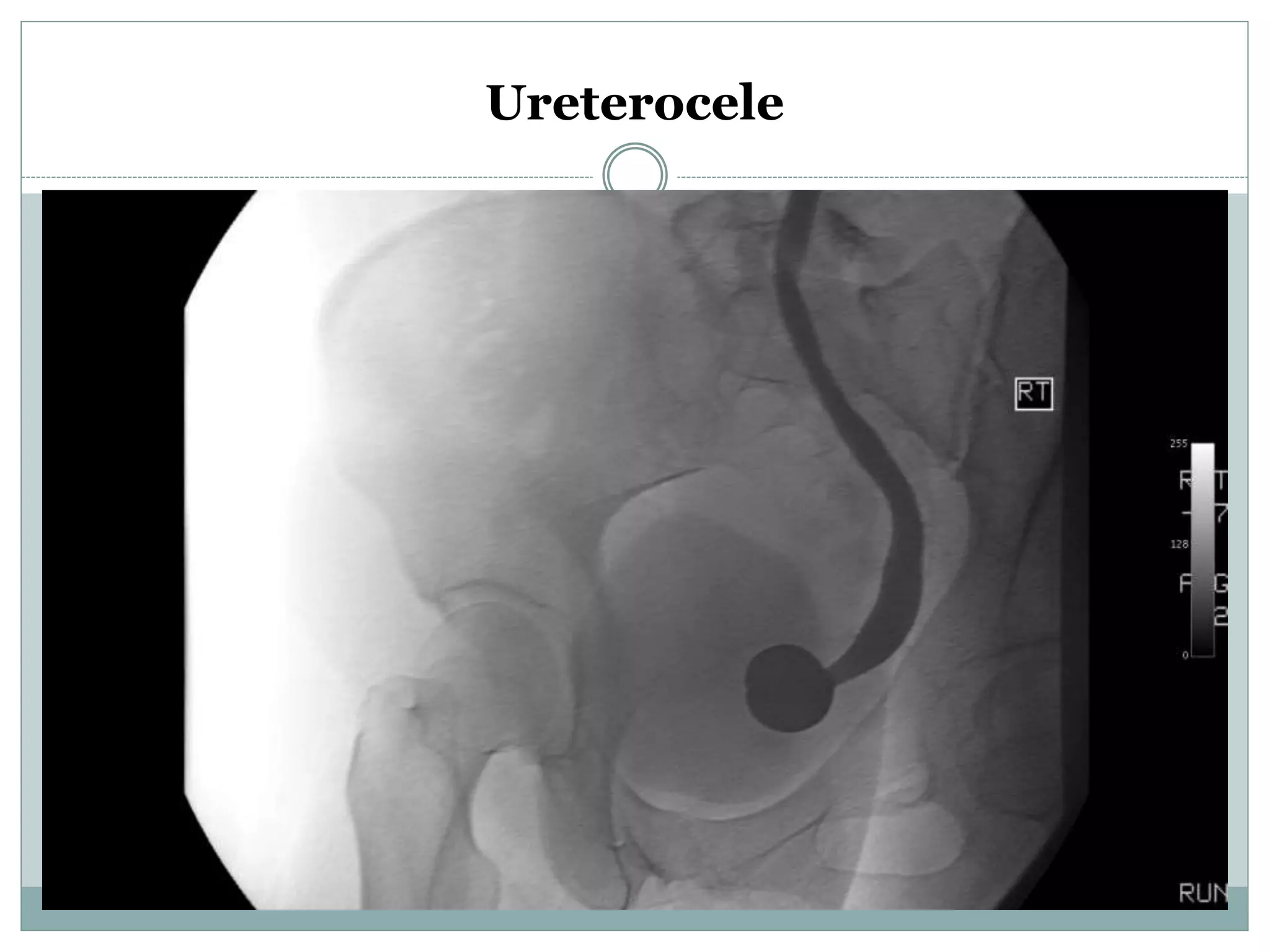 Ectopic ureter & ureterocoele | PPTX