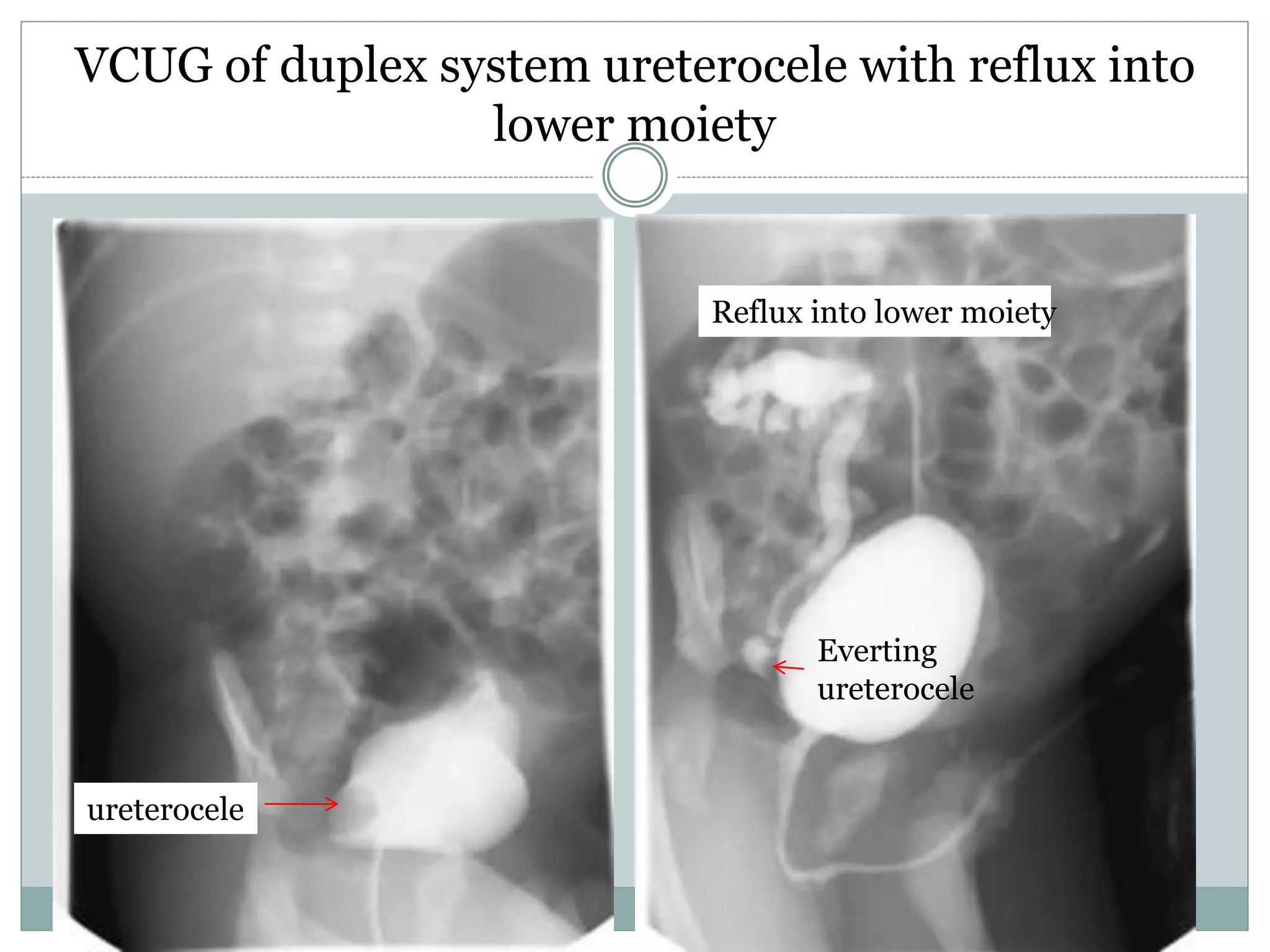 Ectopic ureter & ureterocoele | PPTX
