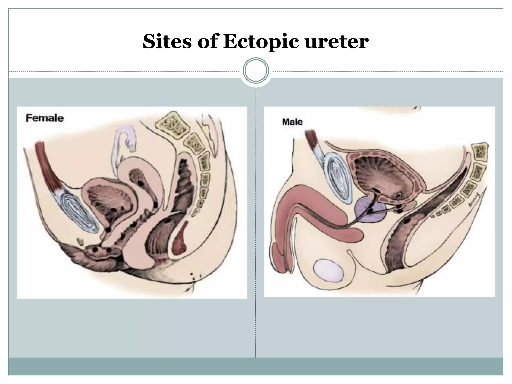 Ectopic ureter & ureterocoele | PPTX