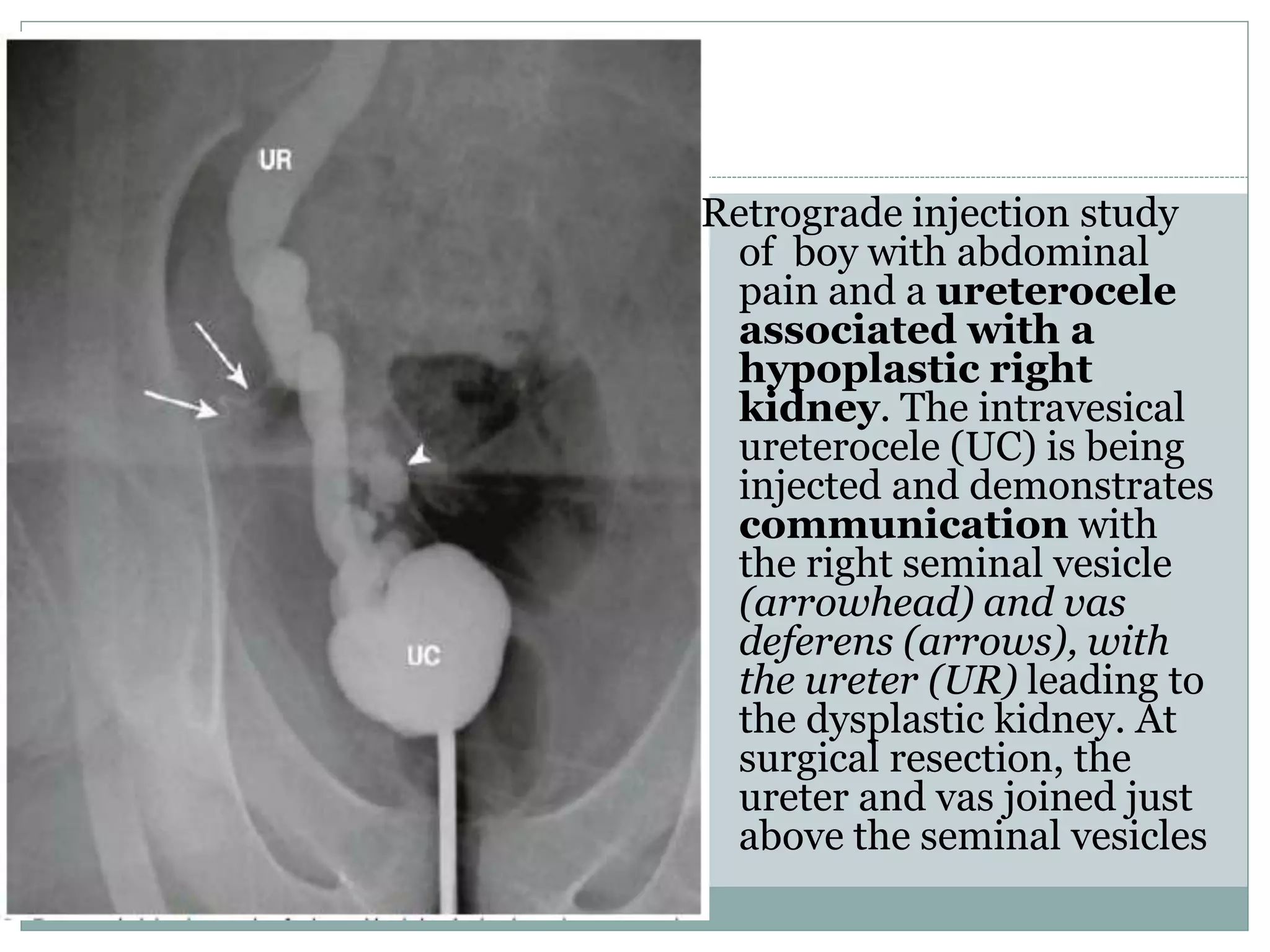 Ectopic ureter & ureterocoele | PPTX