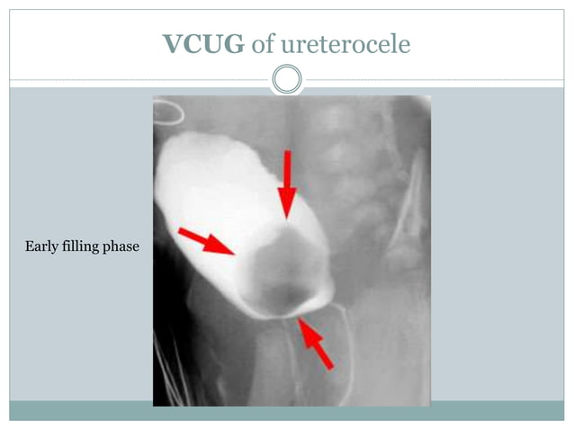 Ectopic ureter & ureterocoele | PPTX
