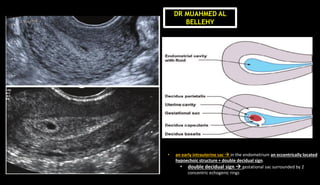 ectopic pregnancy Ultrasound Daignosis.pdf