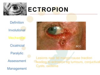 Ectropion | PPT