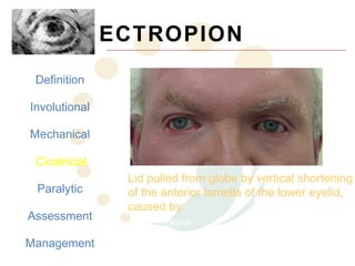 Ectropion | PPT