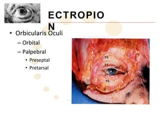 Ectropion | PPT