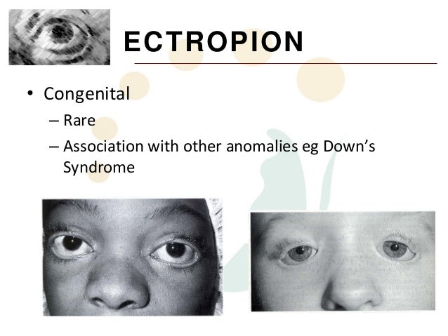 Ectropion