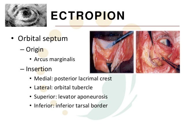 Ectropion