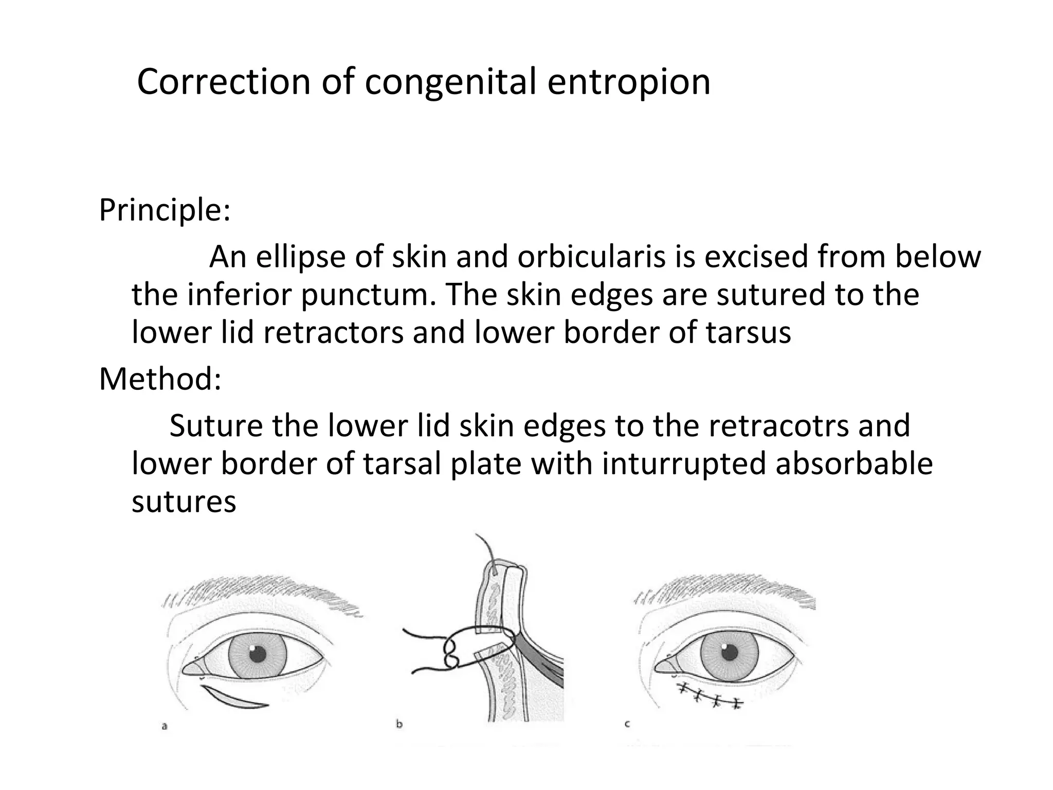 Entropion and its surgical correction | PPT