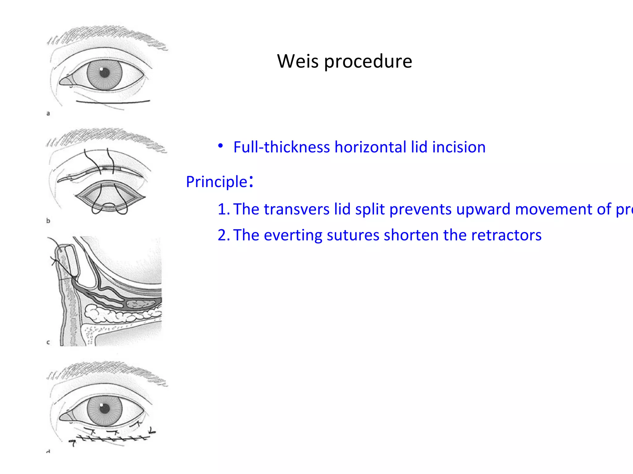 Entropion and its surgical correction | PPT
