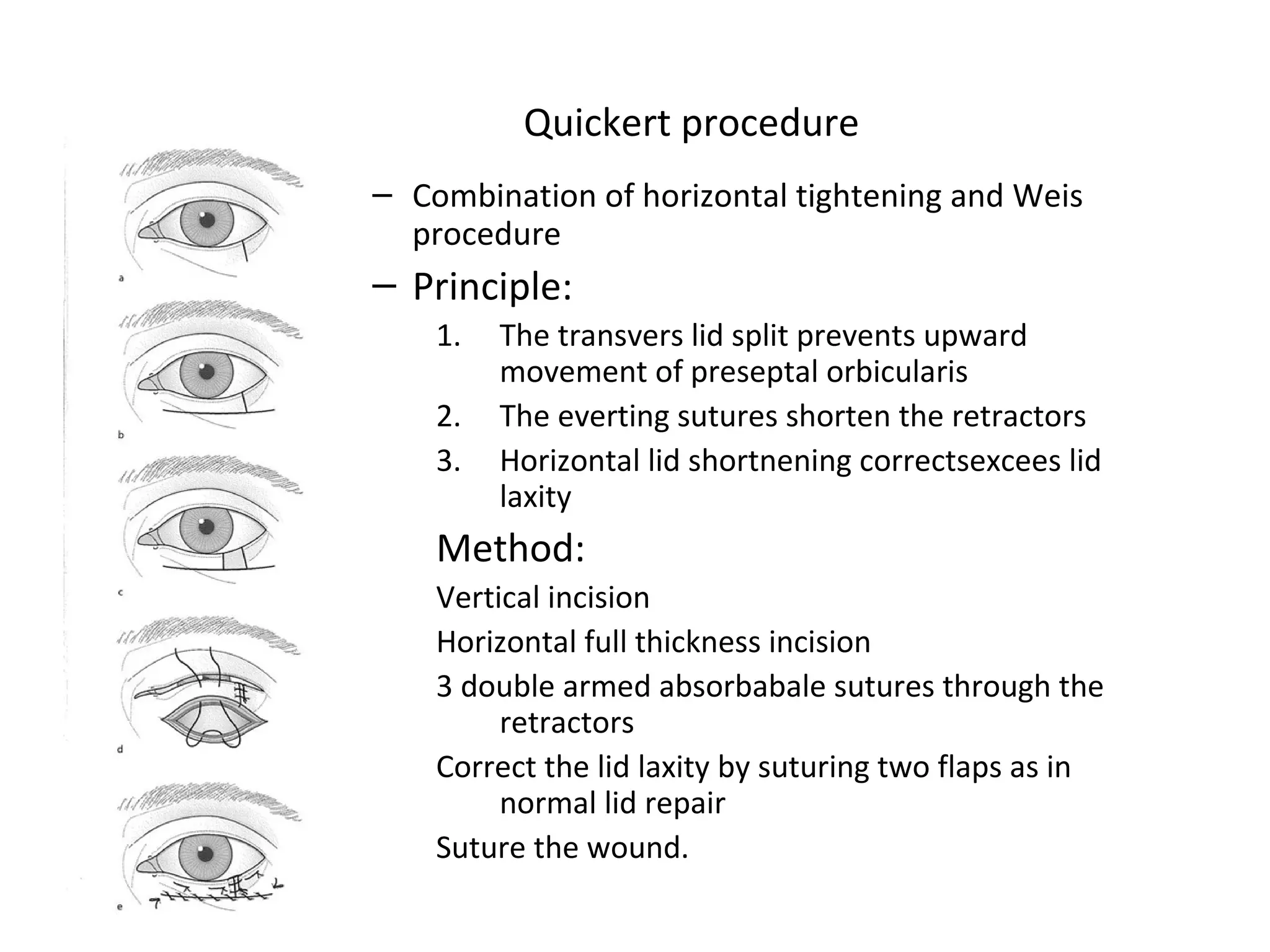 Entropion and its surgical correction | PPT