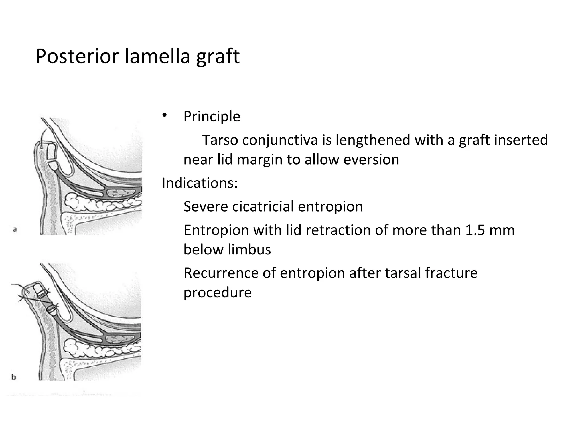 Entropion and its surgical correction | PPT