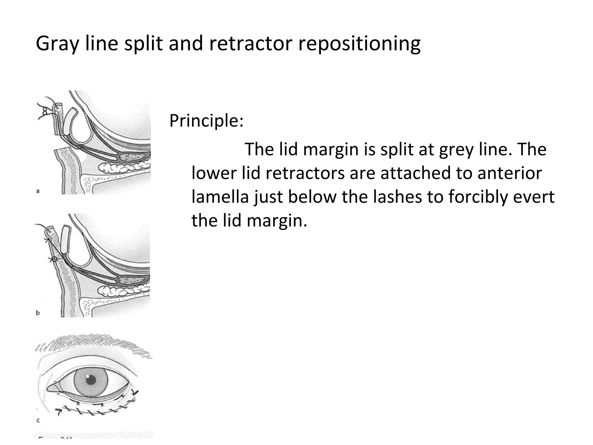 Entropion and its surgical correction | PPT