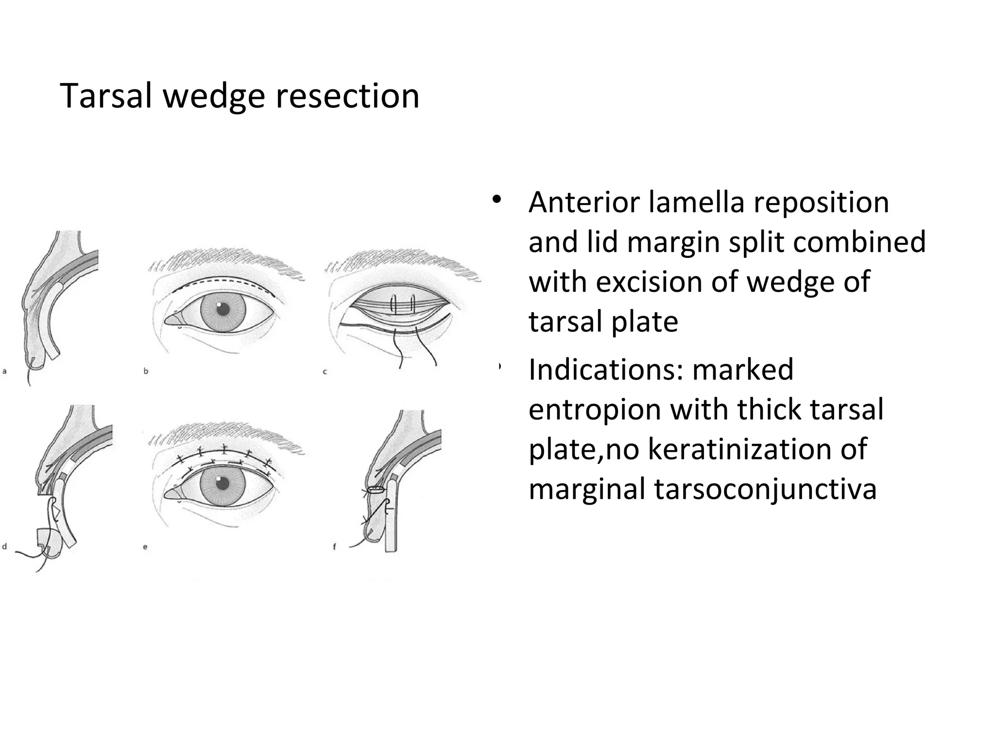 Entropion and its surgical correction | PPT